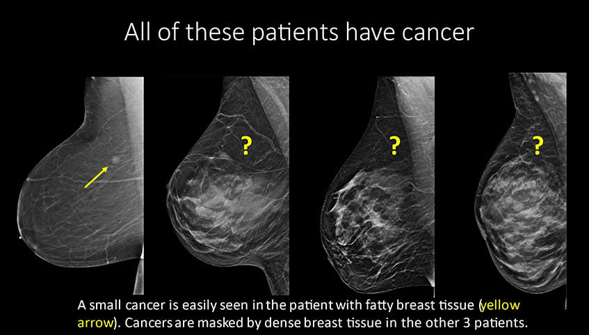 Breast Density’s Relationship to Cancer