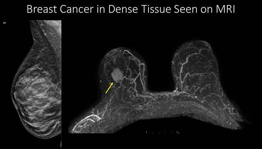 Breast Density’s Relationship to Cancer
